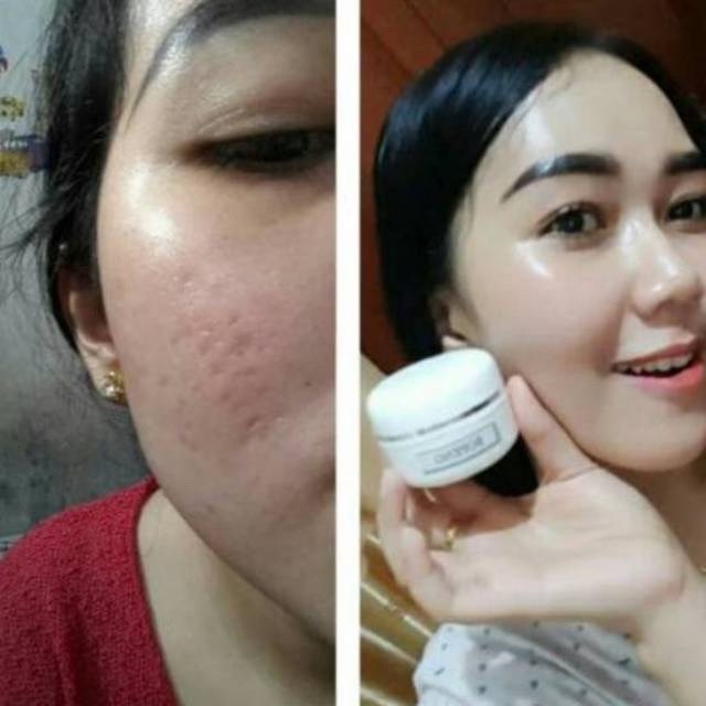 Makeup Menutupi Bopeng | Saubhaya Makeup