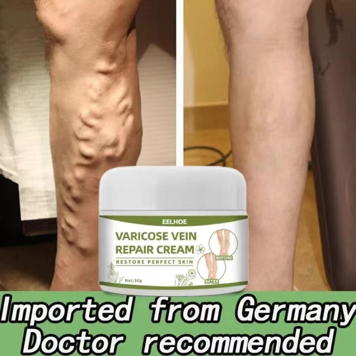 Jual Varicose Veins Cream Obat Varises Kaki Ampuh Salep Laba Laba ...